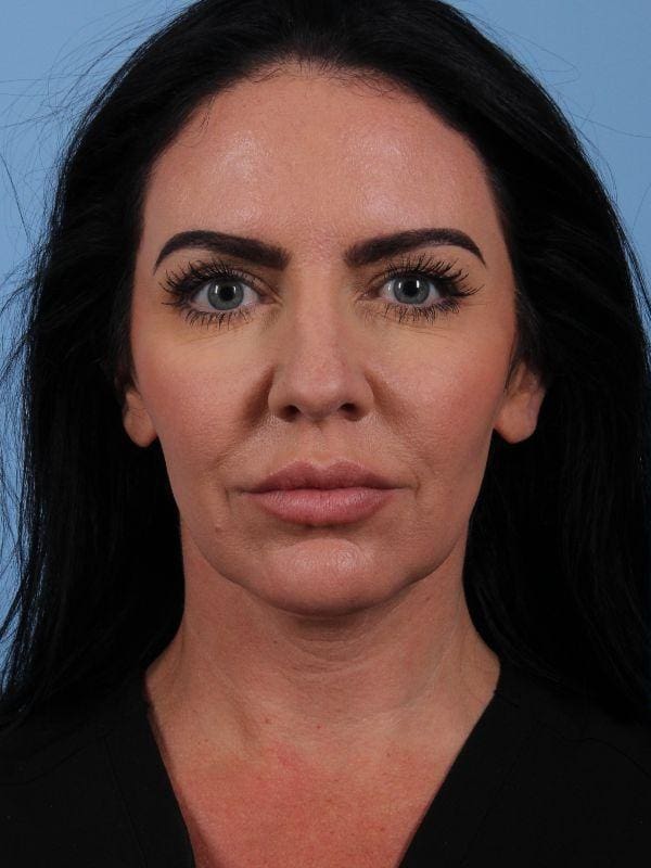 Little Rock Injectable Fillers Patient Photo Case 14942